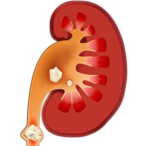 Gansbaai Blog - Hoe om nierstene uit te skei - Xplorio™